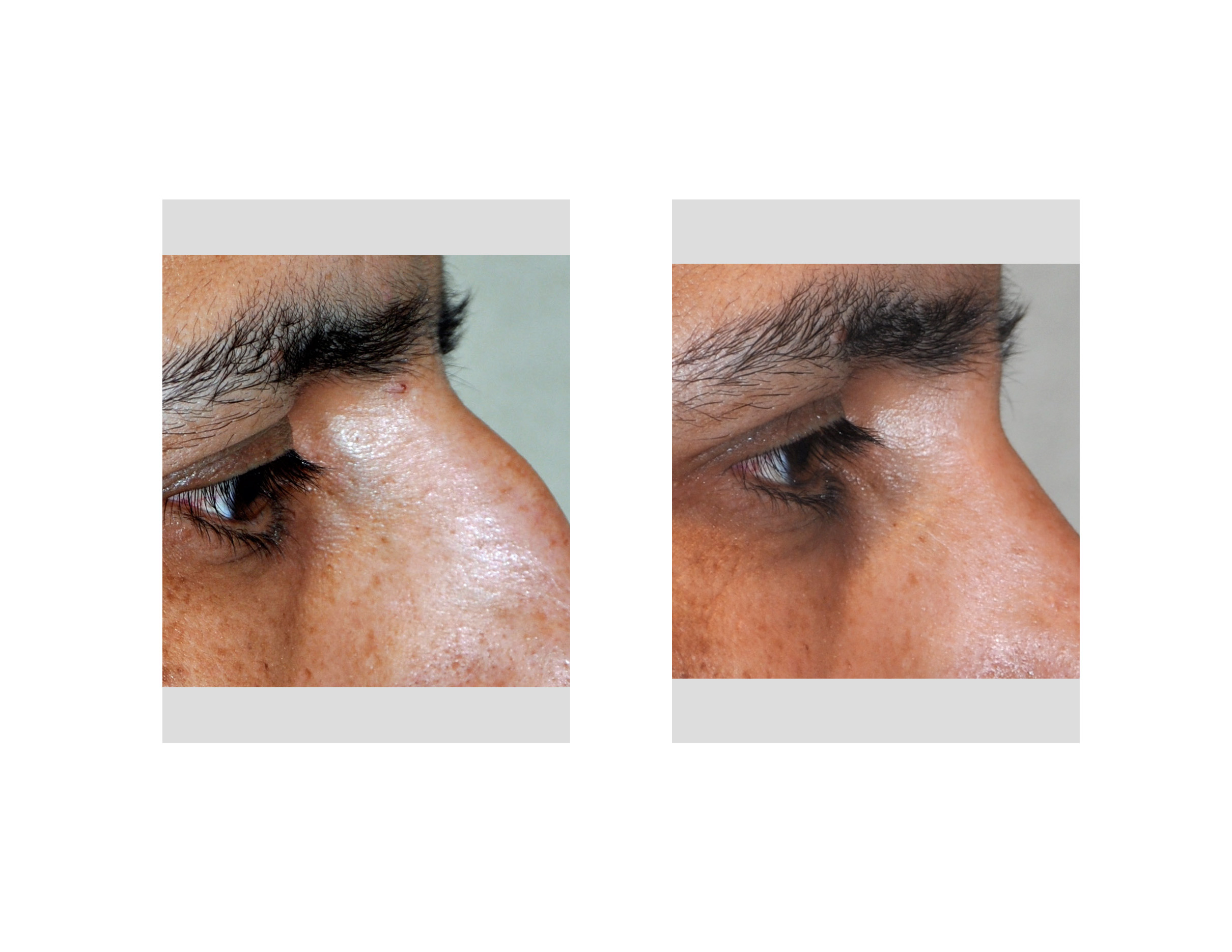 » Blog ArchiveCase Study: The High Radix Rhinoplasty