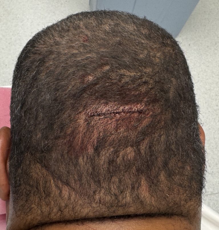 occipital knob incision closure Dr Barry Eppley - Explore Plastic Surgery