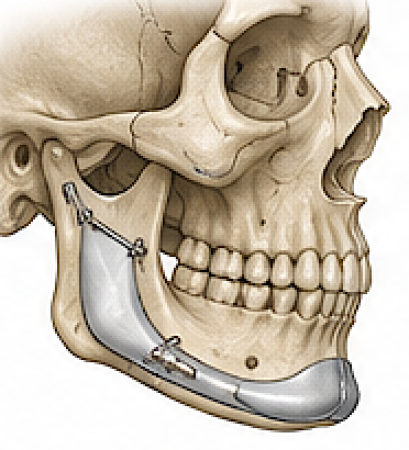 Combining Custom Facial Implants with a Deep Plane Facelift - Explore ...