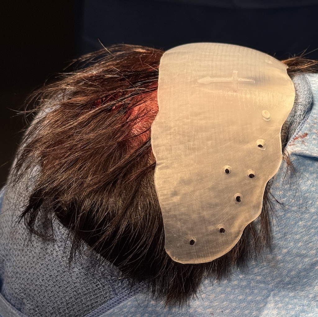 Custom Secondary Occipital Skull Extension Implant Case Example ...
