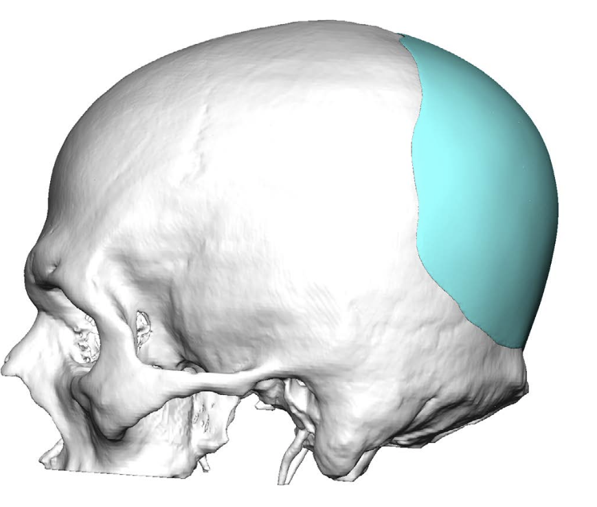 Custom Secondary Occipital Skull Extension Implant Case Example ...