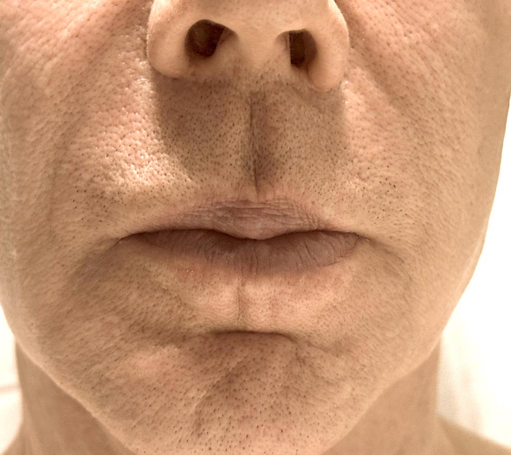 Male Mouth Widening Surgery Results Case Example - Explore Plastic Surgery