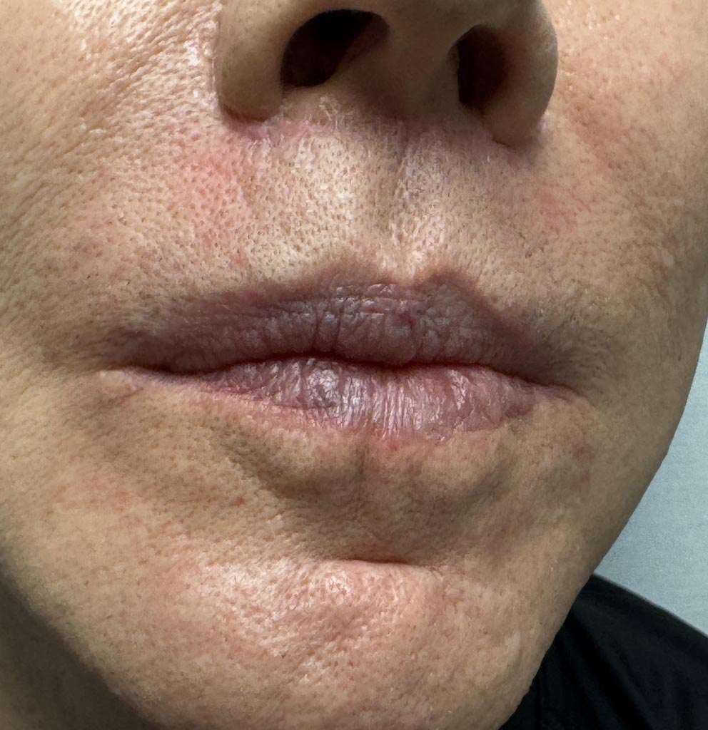 Male Mouth Widening Surgery Results Case Example - Explore Plastic Surgery